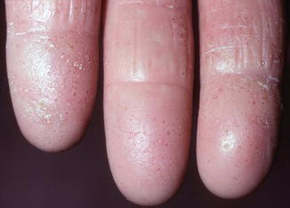 Acute and Recurrent Vesicular Hand Eczema | SpringerLink