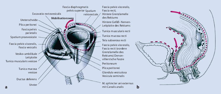 Technik der totalen mesorektalen Exzision (TME) | SpringerLink