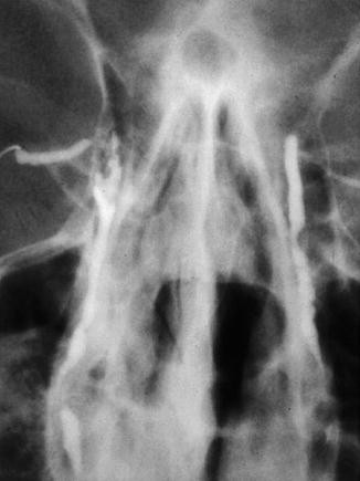 Lacrimal Sac Tumors | SpringerLink