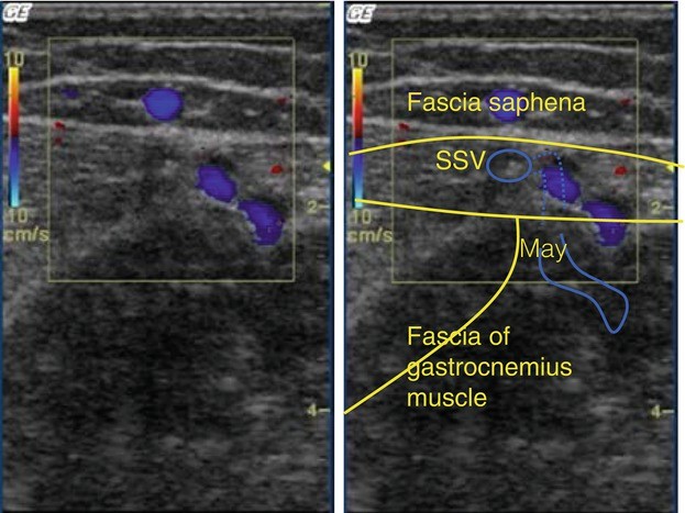 Perforating Veins | SpringerLink