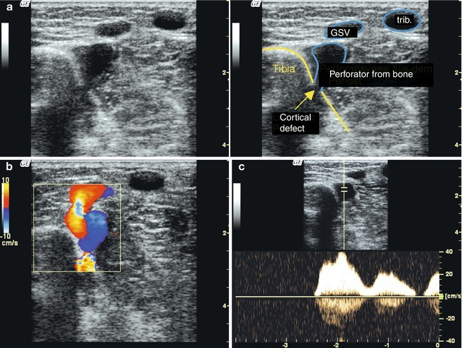 Perforating Veins | SpringerLink