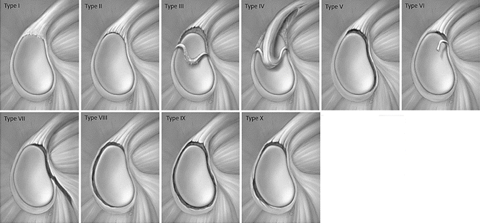 SLAP Lesion: Part I. Pathophysiology and Diagnosis | SpringerLink