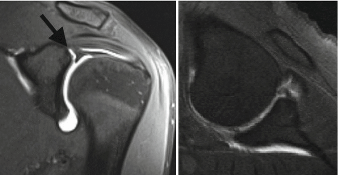 SLAP Lesions Part II: Acute Lesion Versus Chronic Lesion Resulting from ...