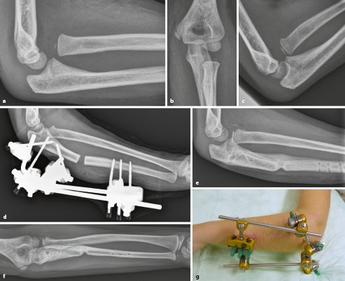 Unterarm | SpringerLink