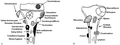 Knochentumoren und pathologische Frakturen | SpringerLink