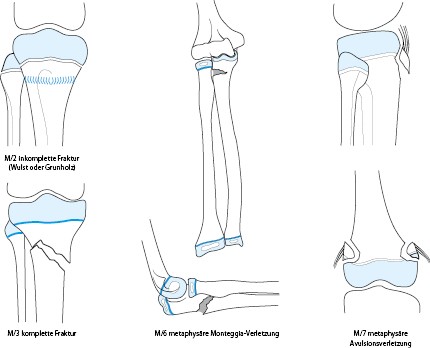Frakturklassifikationen im Kindesalter | SpringerLink