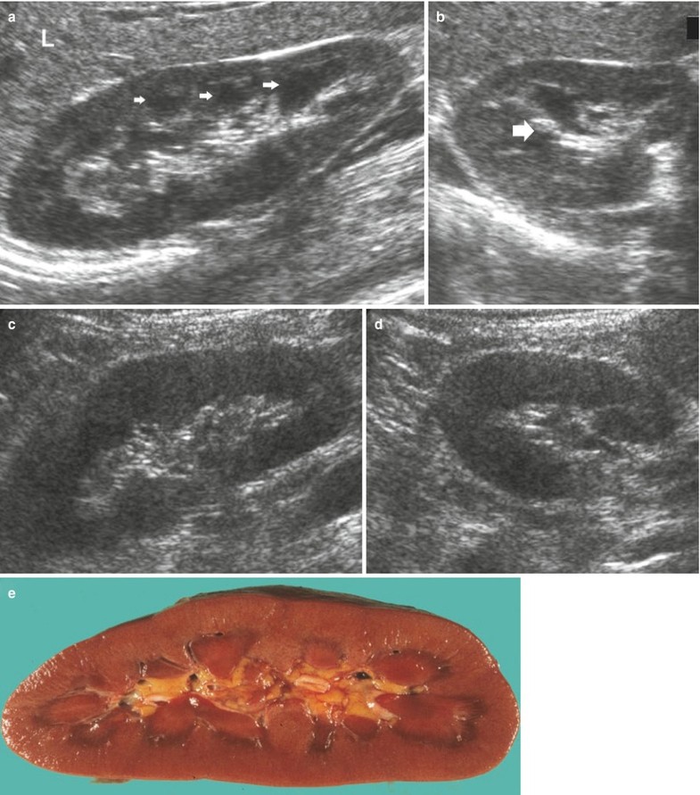 Normal Radiological Anatomy and Anatomical Variants of the Kidney ...