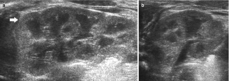 Normal Radiological Anatomy and Anatomical Variants of the Kidney ...