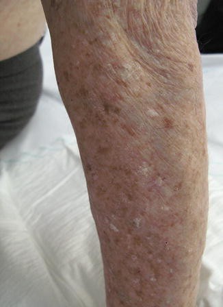 Xerosis Means “Dry Skin”: Mechanisms, Skin Conditions, and Its ...