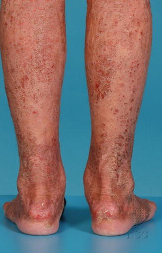 Filaggrin and Skin Infections | SpringerLink