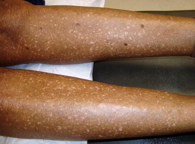 Idiopathic Guttate Hypomelanosis | SpringerLink