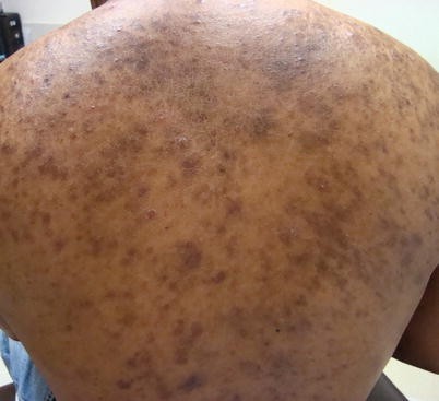 Post-inflammatory Hyperpigmentation | SpringerLink