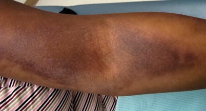 Post-inflammatory Hyperpigmentation | SpringerLink