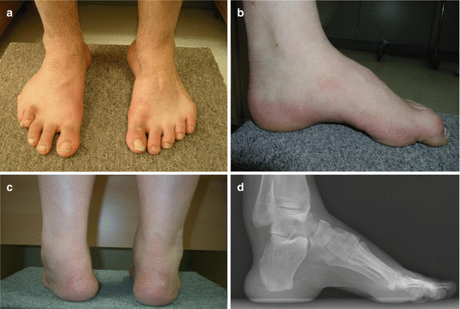 Cavus Foot | SpringerLink