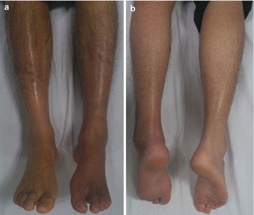 Complex Regional Pain Syndrome in the Foot and Ankle | SpringerLink