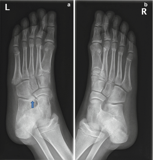Congenital Flatfoot, Painful Accessory Navicular, and Tarsal Coalition ...