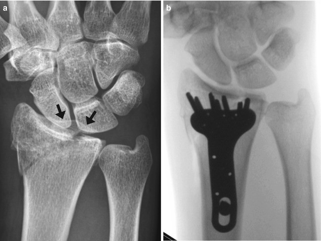 Radial Styloid Fractures and Associated Carpal Injuries | SpringerLink