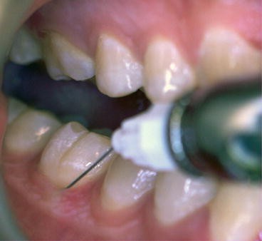 Local Anesthesia | SpringerLink