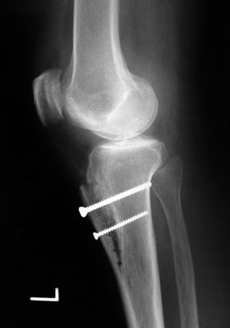 Elmslie-Trillat Procedure: A Distal-Based Procedure for Patellar ...