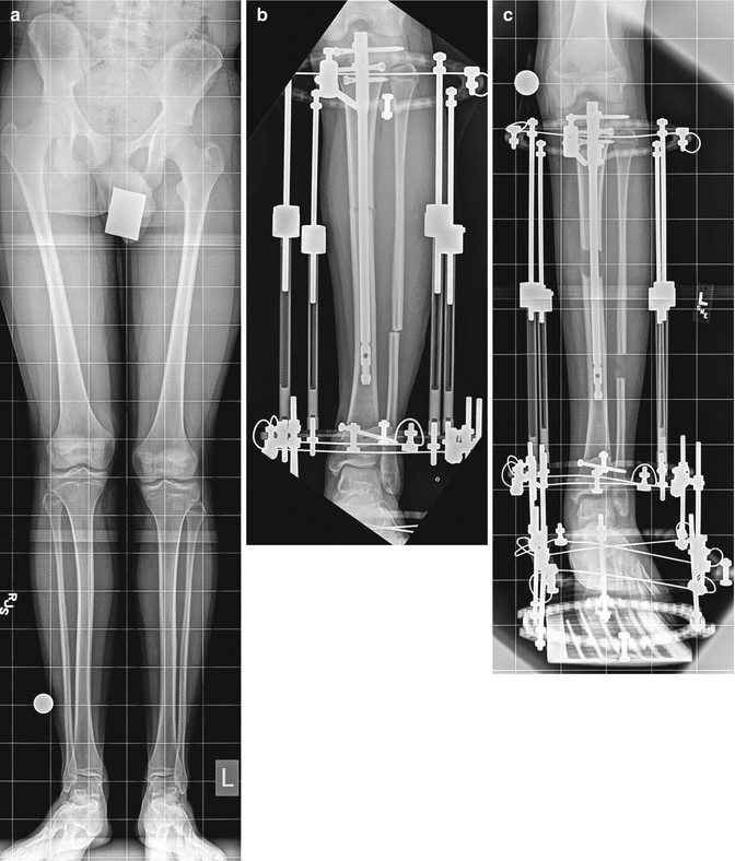 Lengthening over Nails (LON): Femur and Tibia | SpringerLink