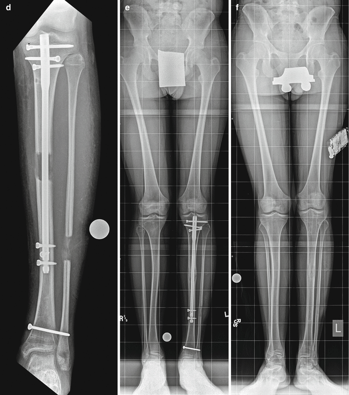 Lengthening over Nails (LON): Femur and Tibia | SpringerLink