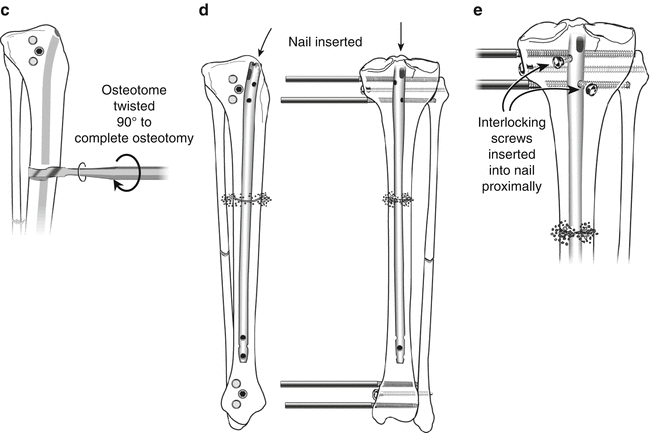 Lengthening over Nails (LON): Femur and Tibia | SpringerLink