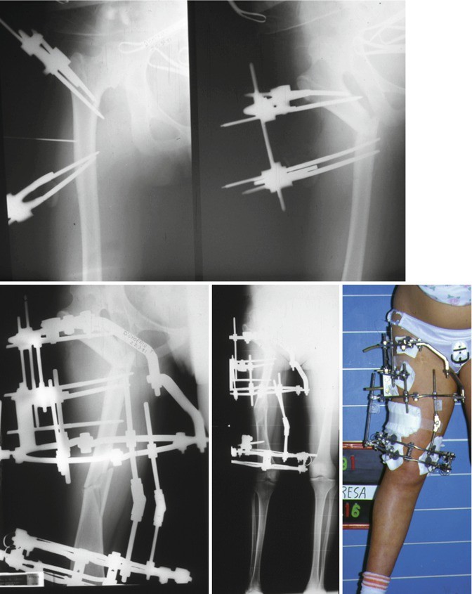 Pelvic Support Osteotomy (PSO): Indications, Limits and Complications ...