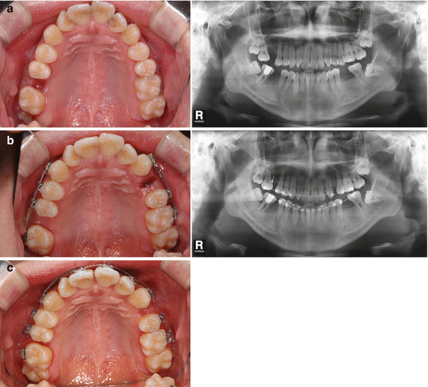 Molar Protraction: Orthodontic Substitution of Missing Posterior Teeth ...