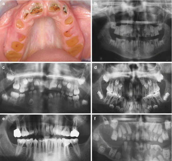 Genetic Alterations: Heritable Dentin Defects | SpringerLink