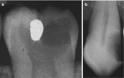Pulp Inflammation: From the Reversible Pulpitis to Pulp Necrosis During ...