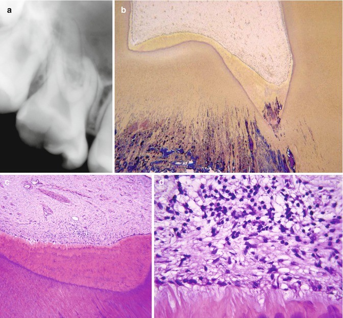Pulp Inflammation: From the Reversible Pulpitis to Pulp Necrosis During ...
