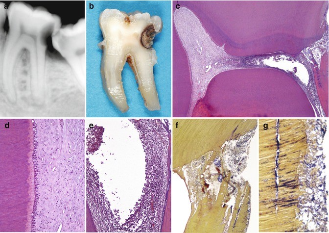 Pulp Inflammation: From the Reversible Pulpitis to Pulp Necrosis During ...