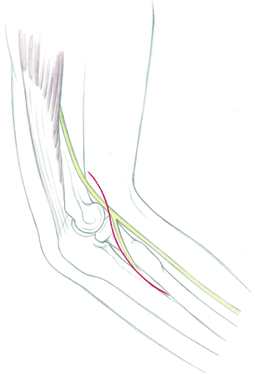 Kompressionssyndrome des N. radialis | SpringerLink