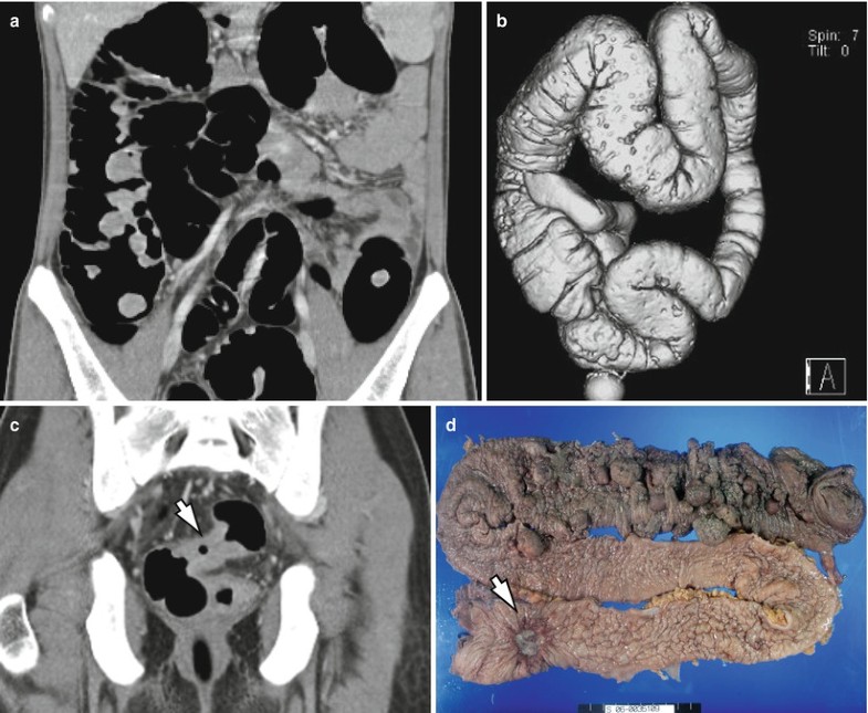 Benign Tumors of the Colon | SpringerLink