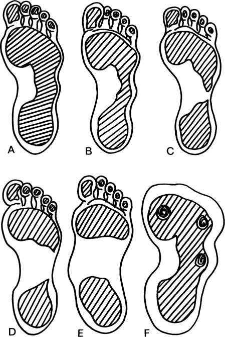 Pes Cavus | SpringerLink