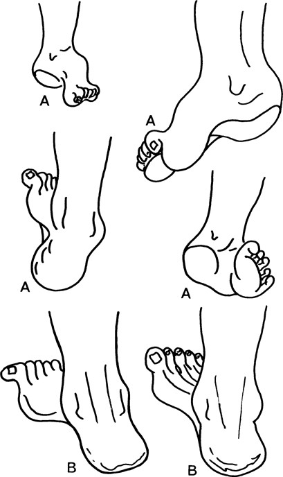 Pes Cavus | SpringerLink