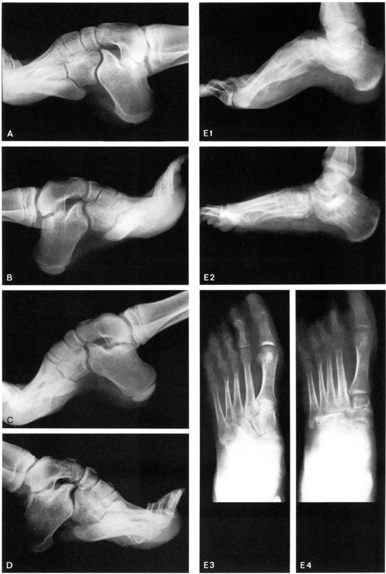 Pes Cavus | SpringerLink