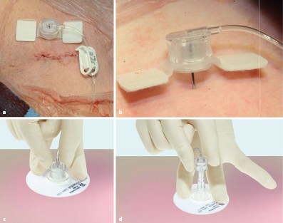 Umgang der Mitarbeiter mit zentralvenösen Ports | SpringerLink