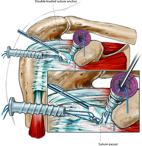 Rotator cuff Repair | SpringerLink