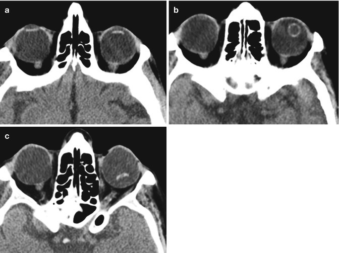 Imaging After Cataract and Intraocular Lens Implant Surgery | SpringerLink