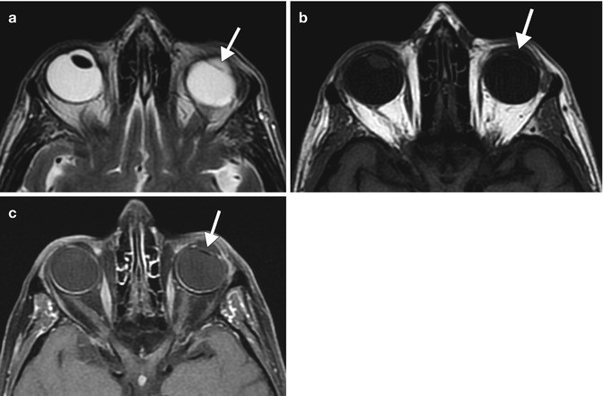 Imaging After Cataract and Intraocular Lens Implant Surgery | SpringerLink