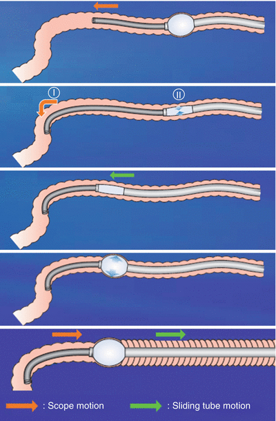 Single-Balloon Enteroscopy | SpringerLink