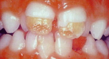 Enamel Defects in the Permanent Dentition: Prevalence and Etiology ...