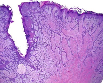 Schweißdrüsentumoren mit apokriner und ekkriner Differenzierung ...