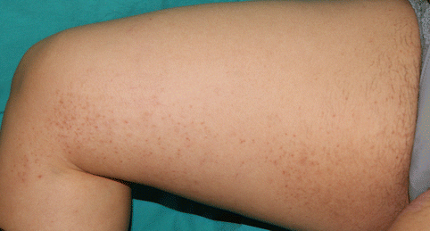 Darier’s Disease | SpringerLink