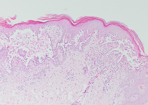 Hailey-Hailey Disease (Familial Benign Pemphigus) | SpringerLink