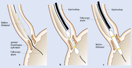 Endoskopische Rekanalisationsverfahren | SpringerLink