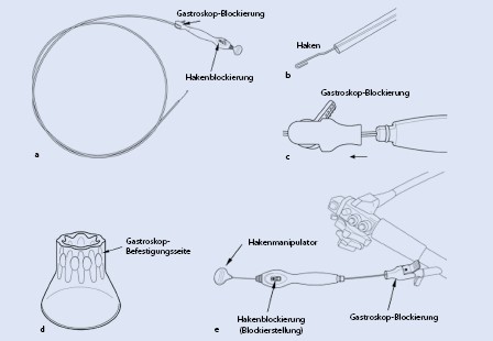 Endoskopische Ernährungstechniken | SpringerLink
