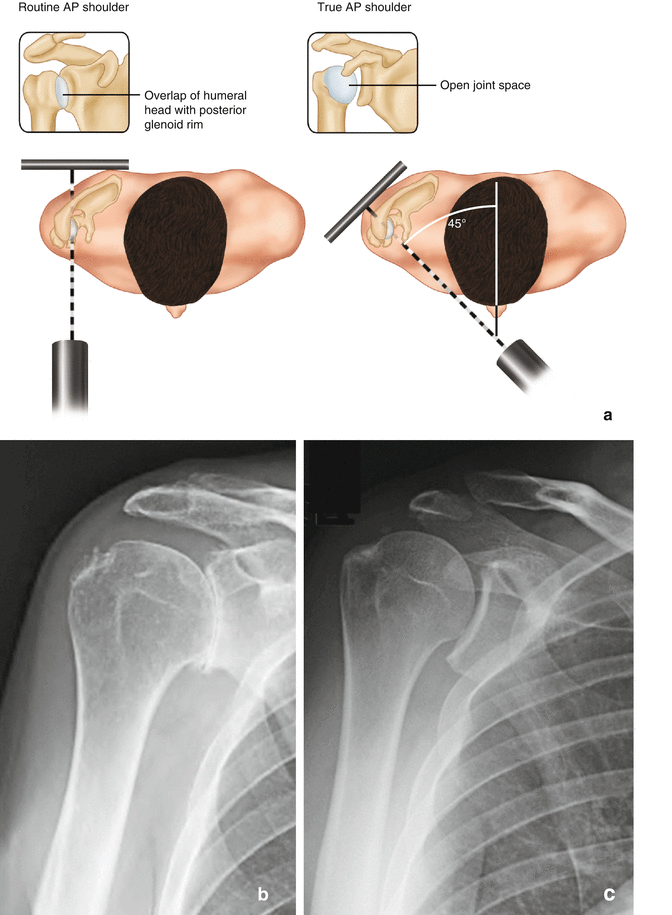 Subacromial Space | SpringerLink