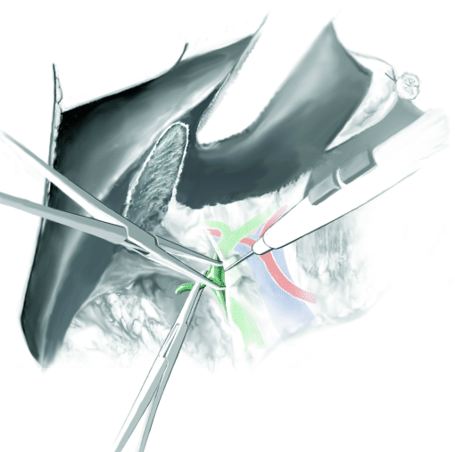 Choledochojejunostomy and Cholecystojejunostomy | SpringerLink